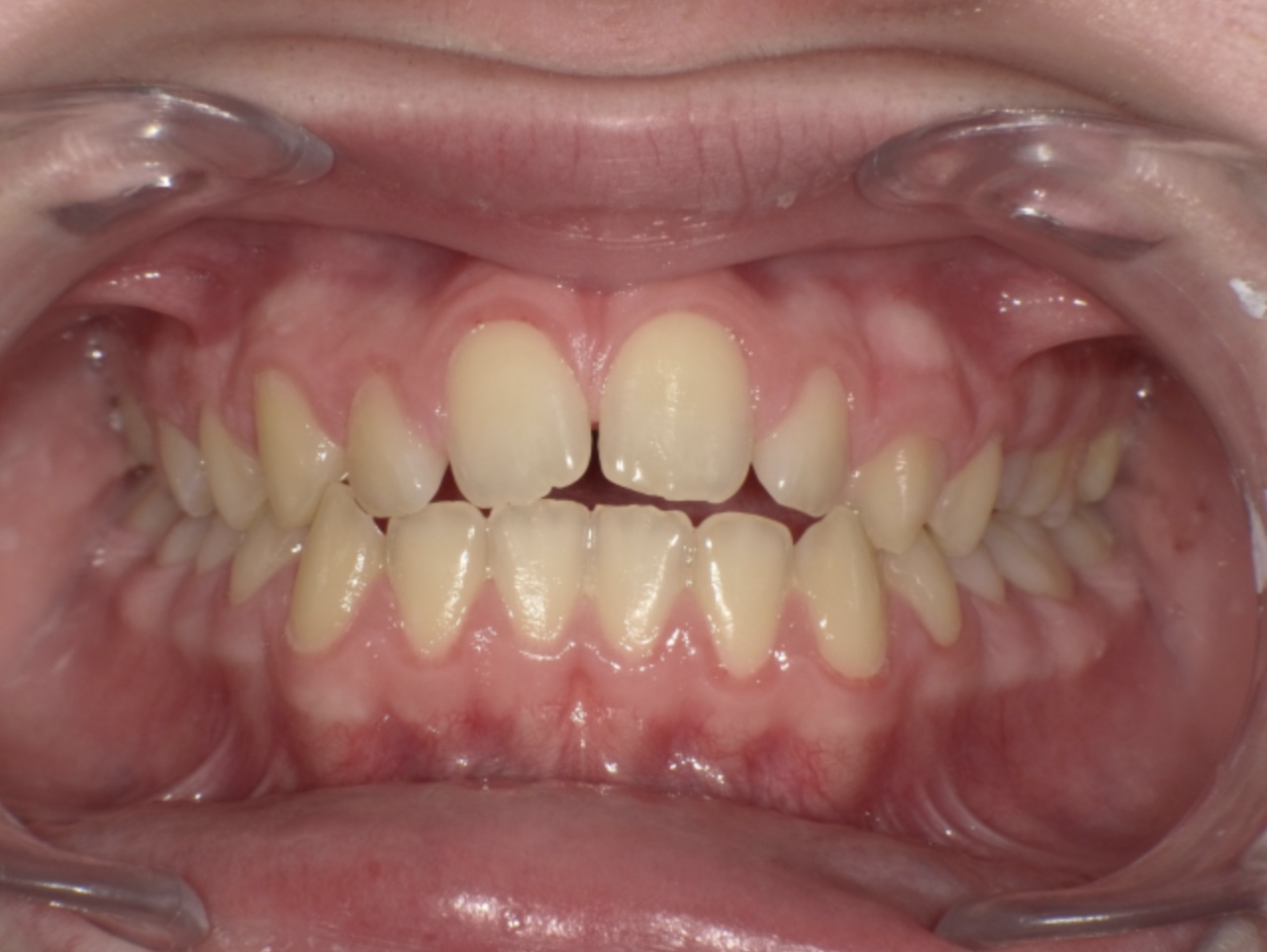 Les cas cliniques avant/après d’orthodontie du Dr. Antoine Gourdin